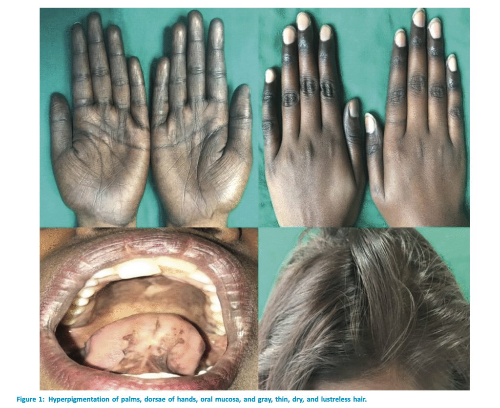 Mucocutaneous hyperpigmentation as presentation of vitamin B12 ...